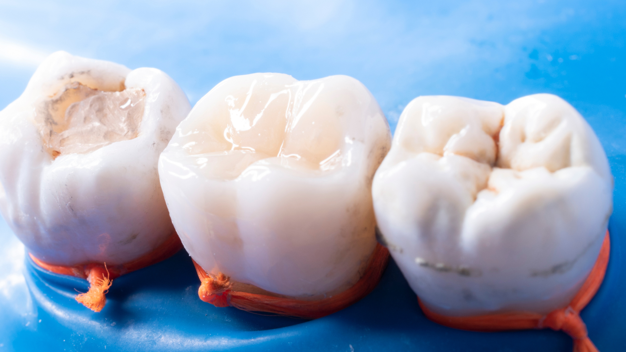 Kids Tooth Filling – Tooth Repair and Recovery Time - Webcity